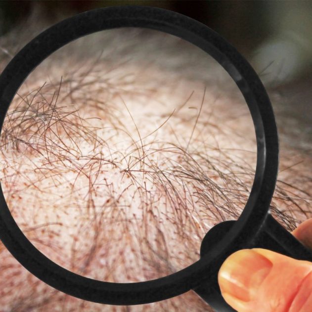 What is the cause of hair loss? – Net 3 Media
